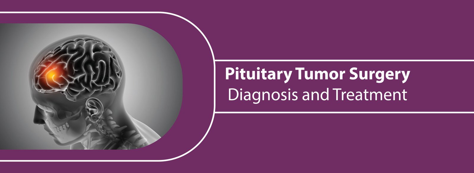 Pituitary Tumor Surgery: Diagnosis & Treatment | ACE ENT Clinic