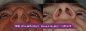 Nasal Septum Holes: Causes, Surgery, and Treatment