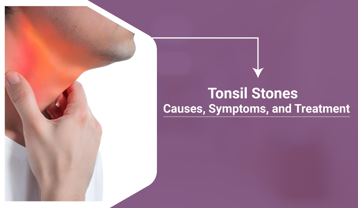 Tonsil Stones: Causes, Symptoms, and Treatment - ACE ENT Clinic Tonsil Stones: Causes, Symptoms, and Treatment - ACE ENT Clinic
